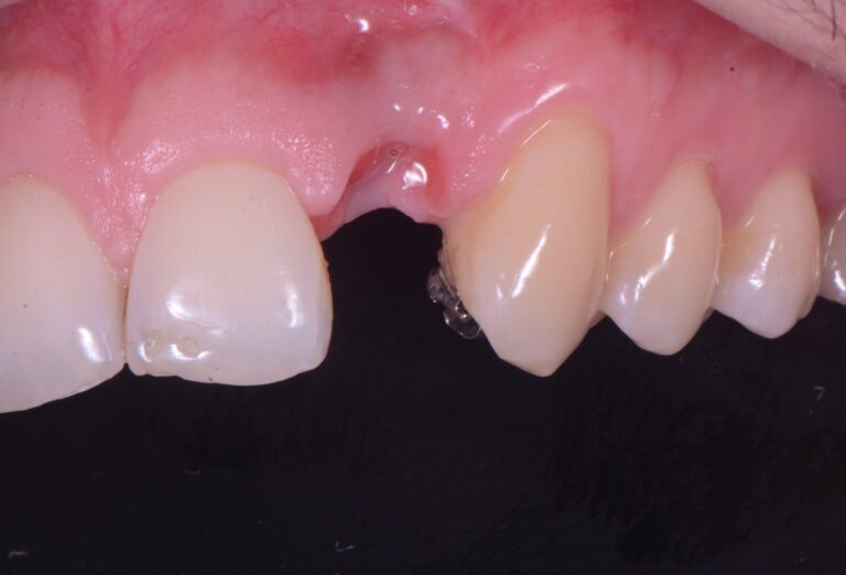 Implants dentaires. Quelles Etapes ? | Chirurgien-dentiste Dr Finelle