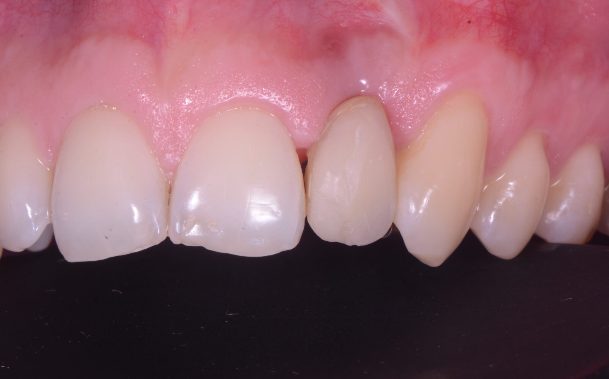 Implants dentaires. Quelles Etapes ? | Chirurgien-dentiste Dr Finelle