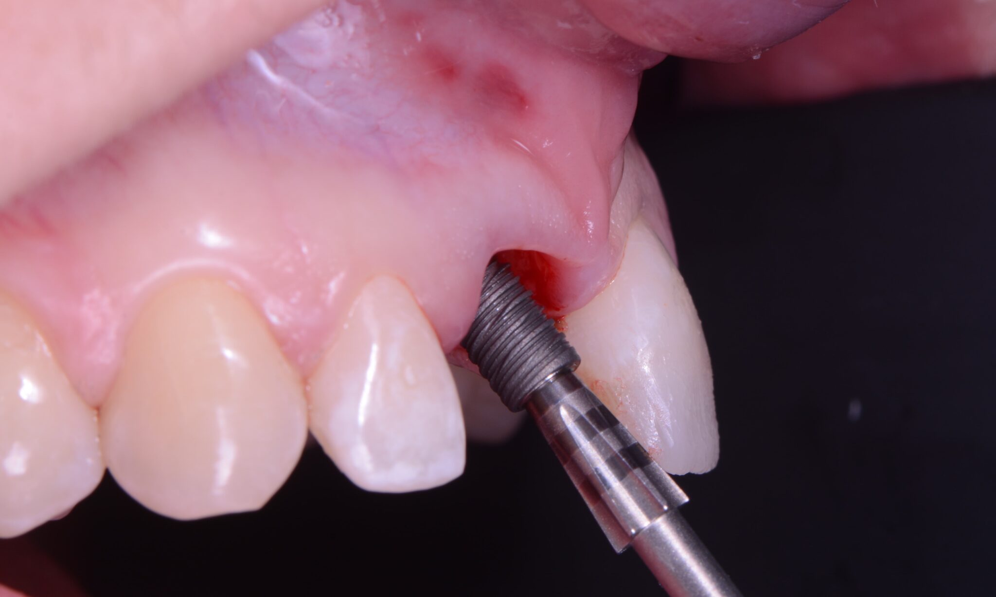 Implants dentaires. Quelles Etapes ? | Chirurgien-dentiste Dr Finelle