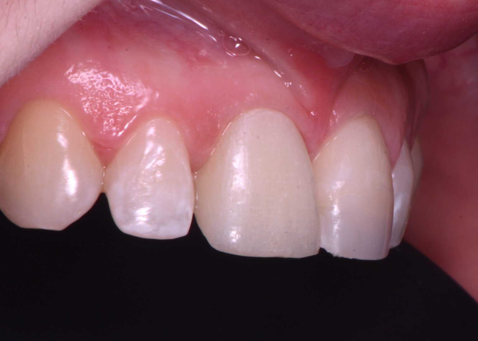 Implants dentaires. Quelles Etapes ? | Chirurgien-dentiste Dr Finelle